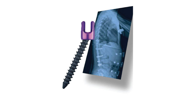 Sistema de instrumentación de columna pediátrico CD LEGACY HORIZON ...